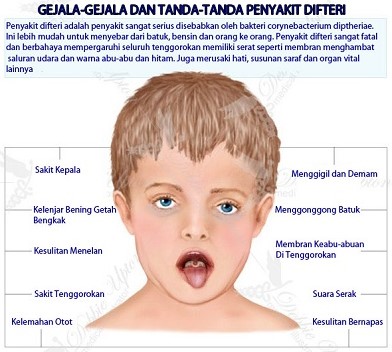 Apa itu Penyakit Difteri? Berikut Gejala, Pencegahan, dan Perawatan ...