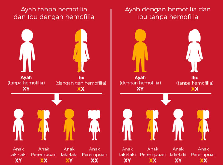 Inilah Penyakit Menurun Seperti Hemofilia disebabkan oleh? – Pasundan ...