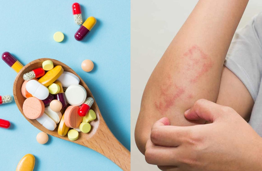 Alergi Obat Kenali Penyebab, Faktor Risiko, Gejala, dan Penanganannya ...