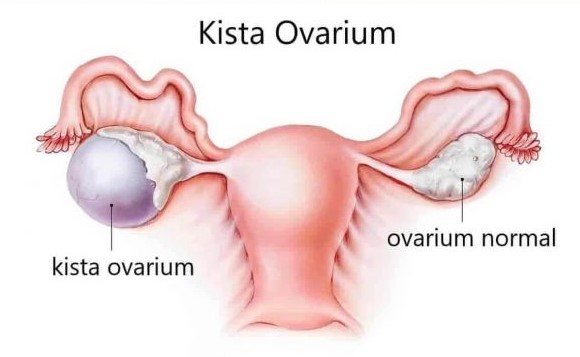 Cari Tahu Penyebab Kista Ovarium Beserta Gejala dan Pengobatannya di Sini – Pasundan Ekspres